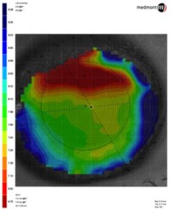 Case Report 1 - Terrien's Marginal Degeneration - Mark Hinds